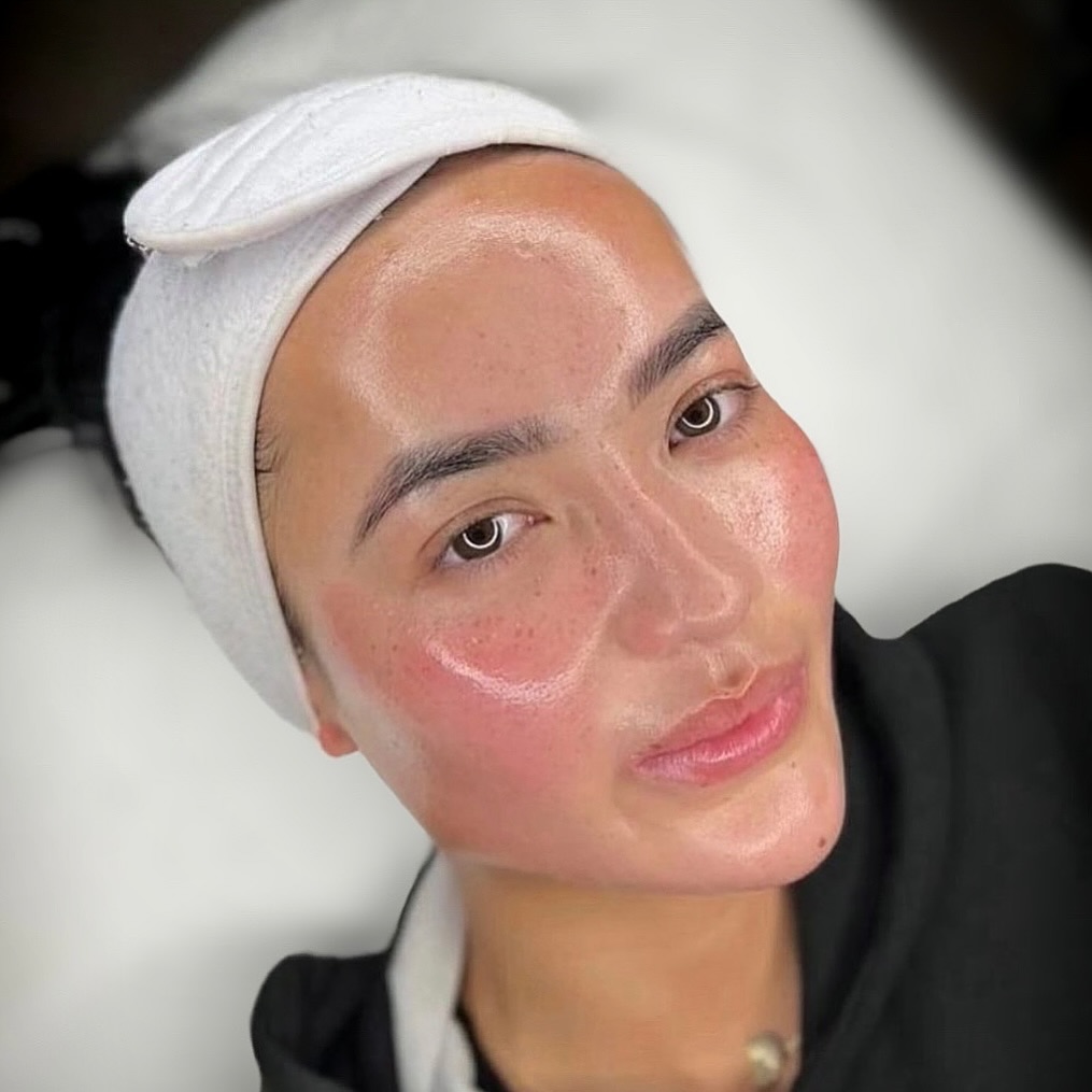 Hydra Needling - Esthétique Lyon